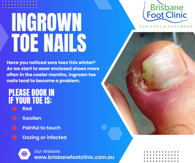 Ingrown toe nails - Brisbane Foot Clinic